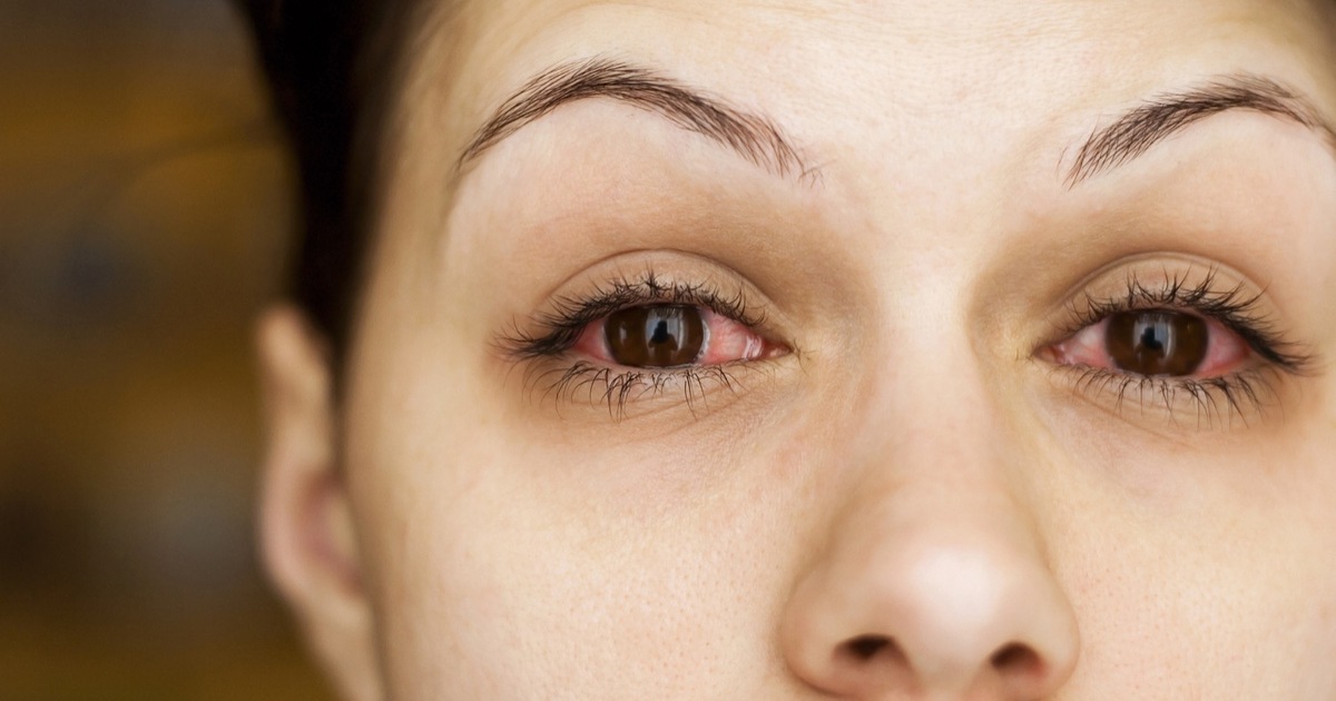Eye Problems In IBD IBD Relief Eye Problems In IBD IBD Relief