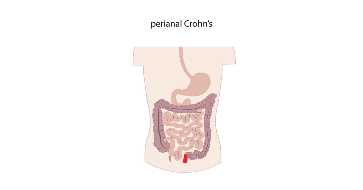 What is perianal Crohn’s? | Crohn’s disease | IBDrelief