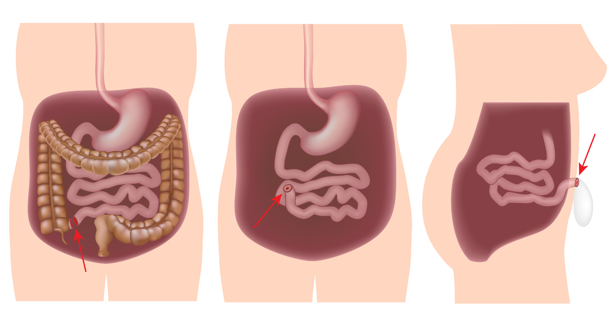 Pan proctocolectomy With Ileostomy Surgery IBDrelief