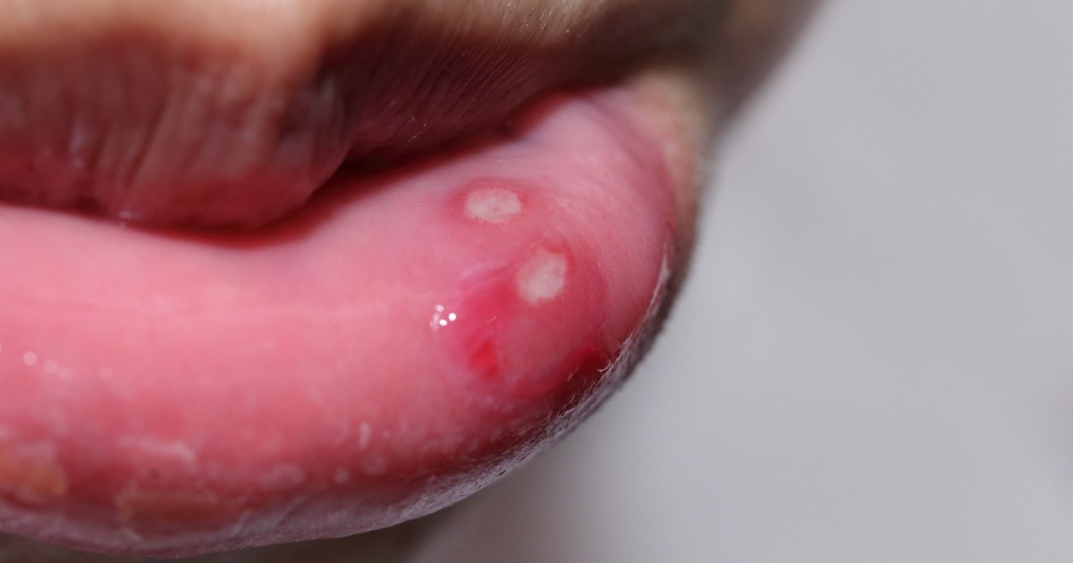 Mouth ulcers Introduction