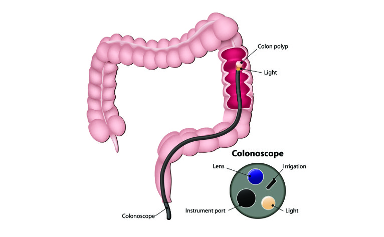 Colonoscopy And Inflammatory Bowel Disease Ibdrelief