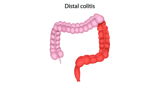 What is ulcerative colitis (UC) | Symptoms | Treatment
