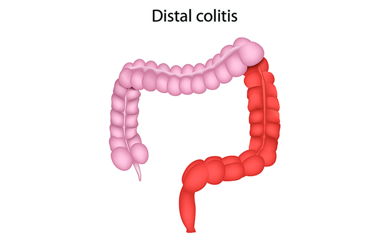 Left-sided (distal) colitis | IBDrelief