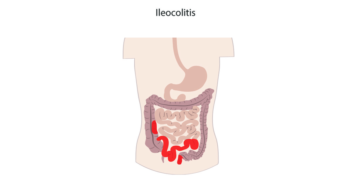 What is ileocolitis? | Crohn's disease | IBDrelief