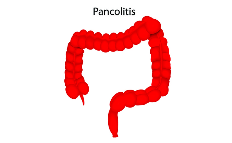 What is Pancolitis | Pancolitis | IBDrelief