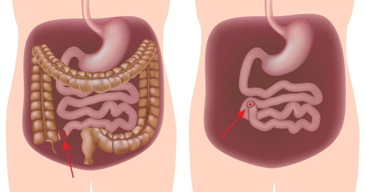 Proctocolectomy Surgery For IBD IBDrelief
