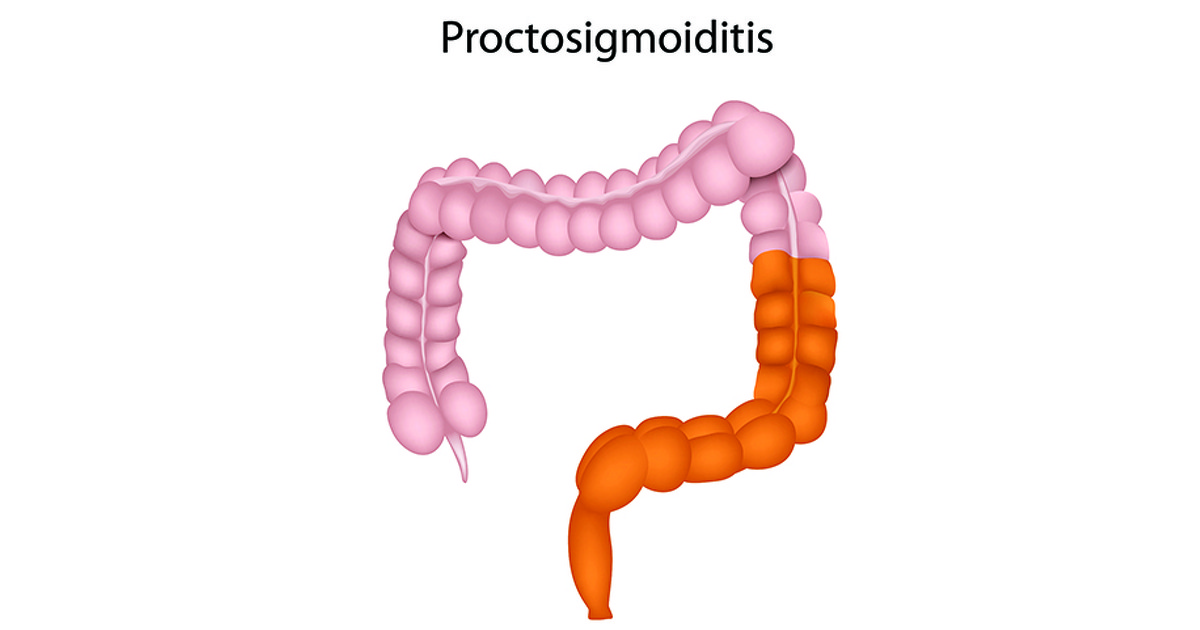 Proctosigmoiditis? | Ulcerative Colitis | IBDrelief