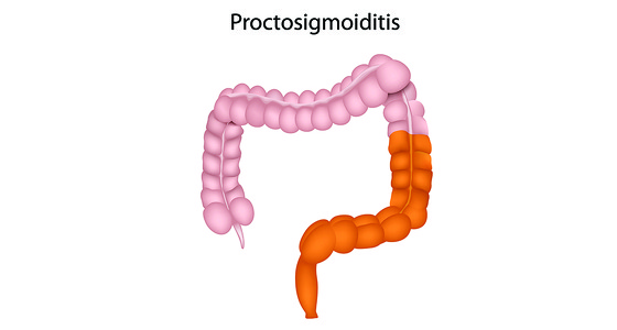 What is ulcerative colitis (UC) | Symptoms | Treatment