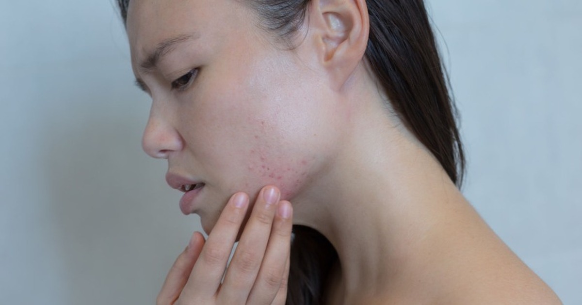 Skin problems and inflammatory bowel disease | IBD Relief